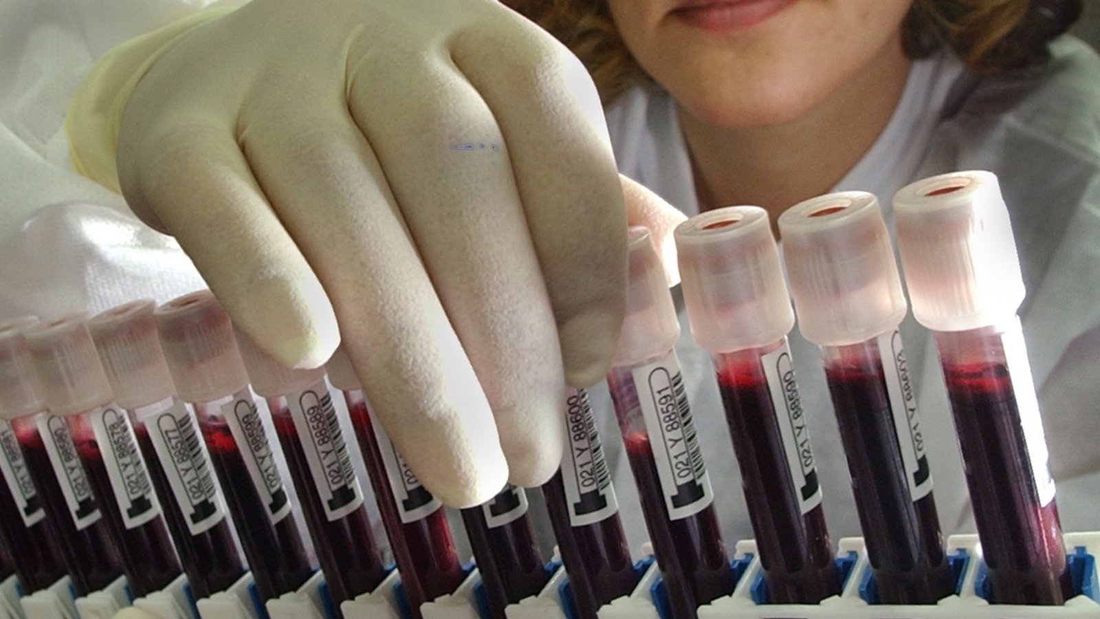 Patients' lab tests delayed by staff shortage